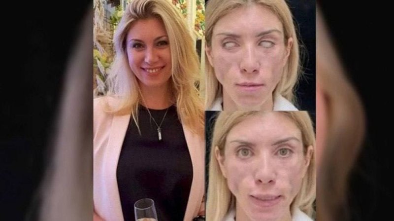 Modelo rusa se opera para verse más joven y ahora no puede mover los ...